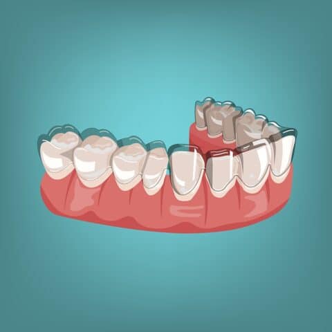 Will Invisalign help TMJ? Discover Your Options for Treatment